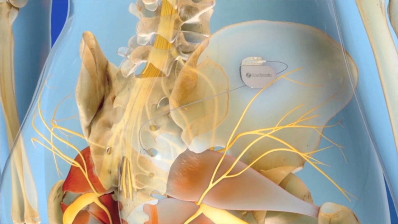 Medtronic's smartphone-based programmer enhances patient experience for ...